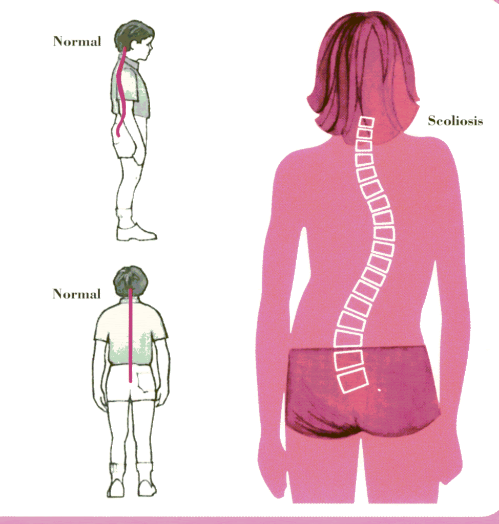 Scoliosis Animated Gifs | Photobucket